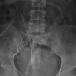 Tenckhoff Catheter - The HKU E-learning Platform in Clinical Medicine ...