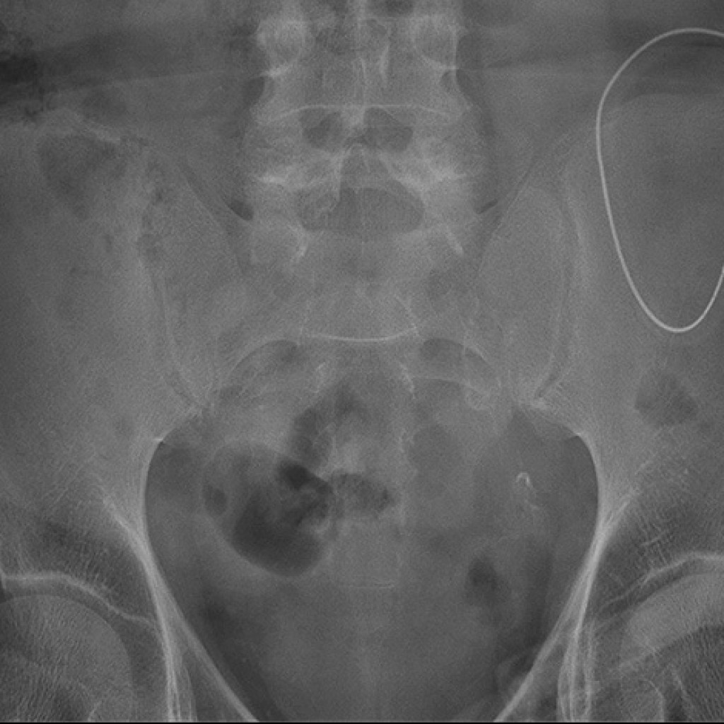 Tenckhoff Catheter - The HKU E-learning Platform in Clinical Medicine ...