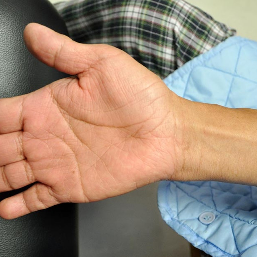 Acromegaly - The HKU E-learning Platform in Clinical Medicine The HKU E ...