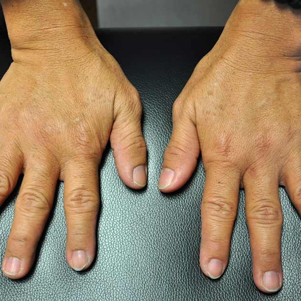 Acromegaly - The HKU E-learning Platform in Clinical Medicine The HKU E ...