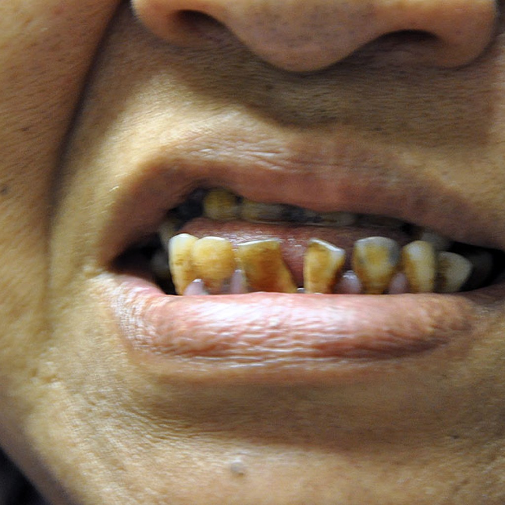 Acromegaly - The HKU E-learning Platform in Clinical Medicine The HKU E ...