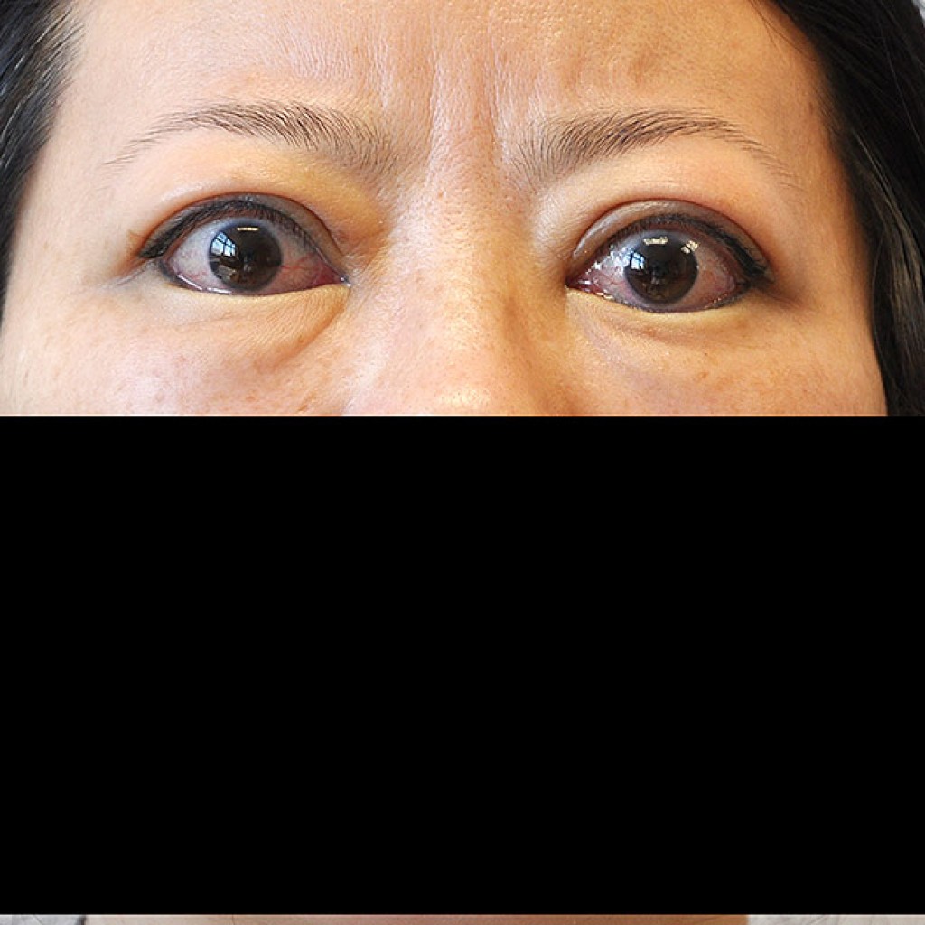 Graves' Disease - The HKU E-learning Platform in Clinical Medicine The ...