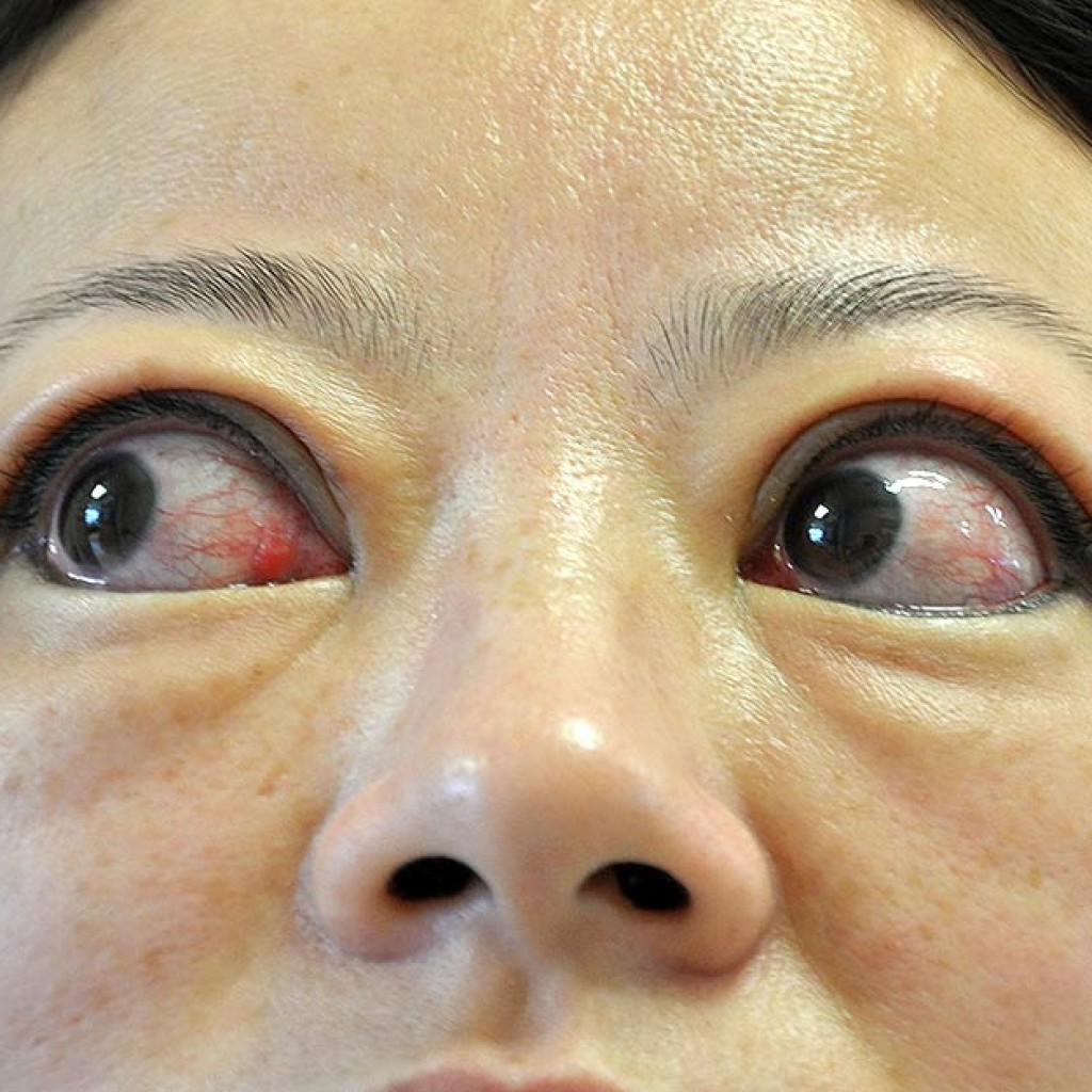 Graves' Disease - The HKU E-learning Platform in Clinical Medicine The ...