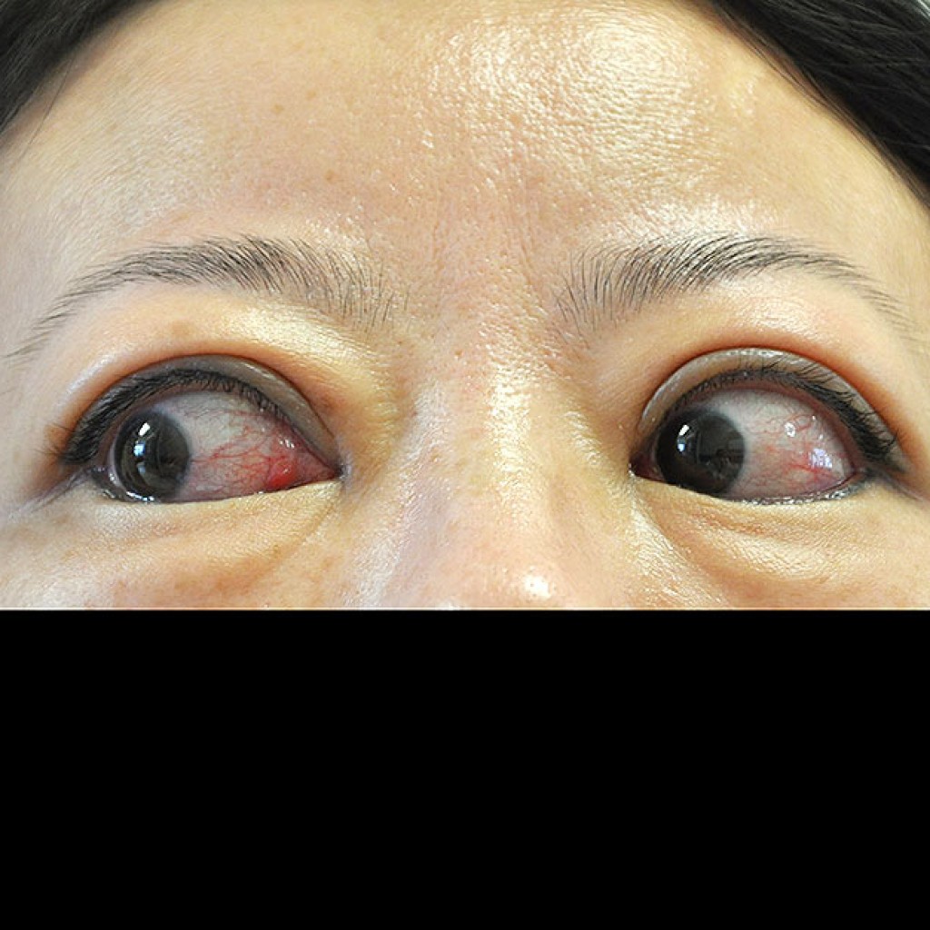 Graves' Disease - The HKU E-learning Platform in Clinical Medicine The ...