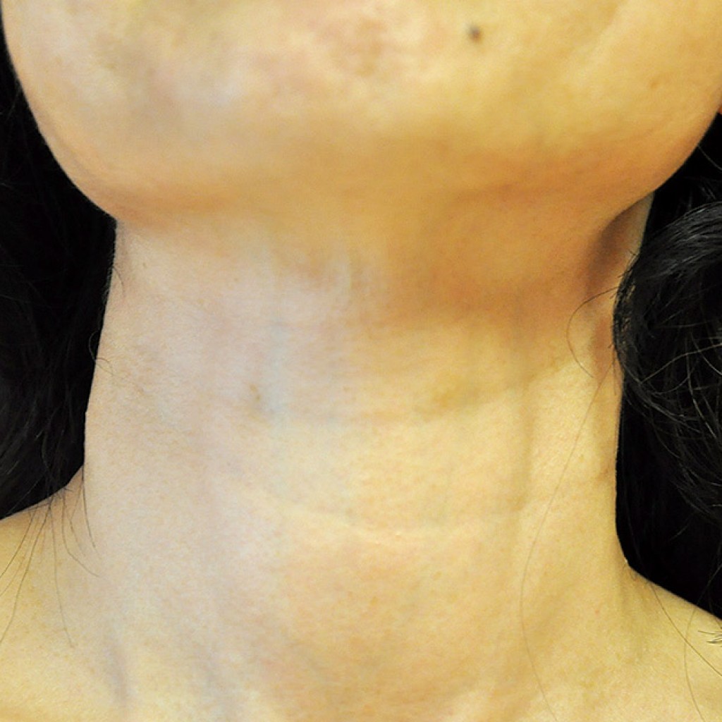 Graves' Disease - The HKU E-learning Platform in Clinical Medicine The ...