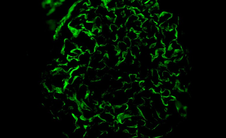 Goodpasture’s Syndrome - The HKU E-learning Platform in Clinical ...